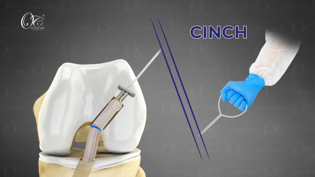 OC EcoButton Flex- The World’s First Hybrid Loop For Cruciate ...