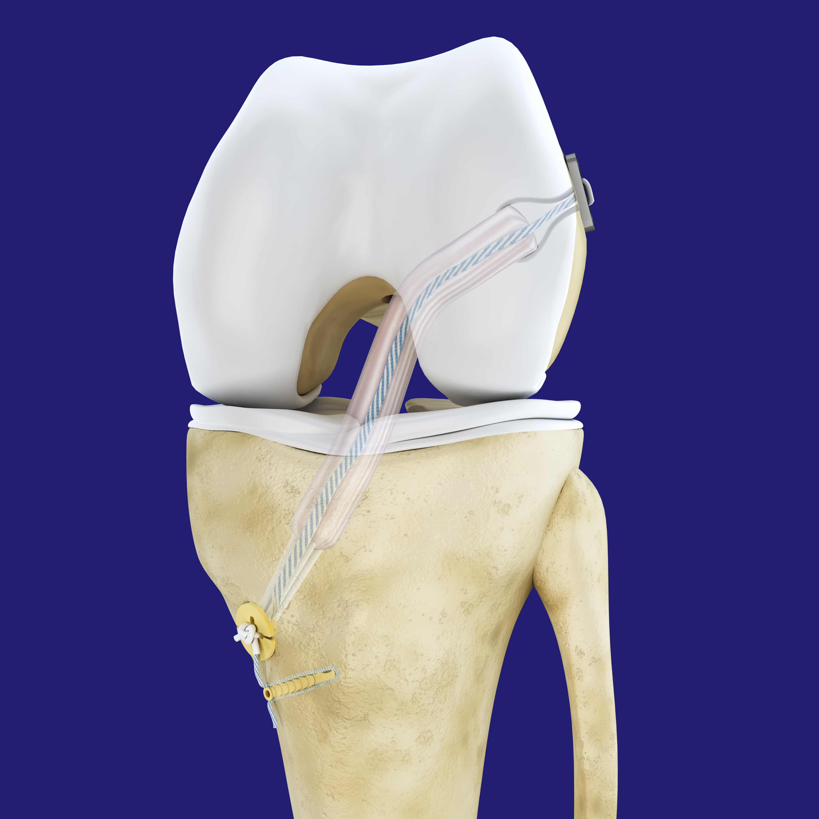Cruciate Repair & Reconstruction – Osteocare