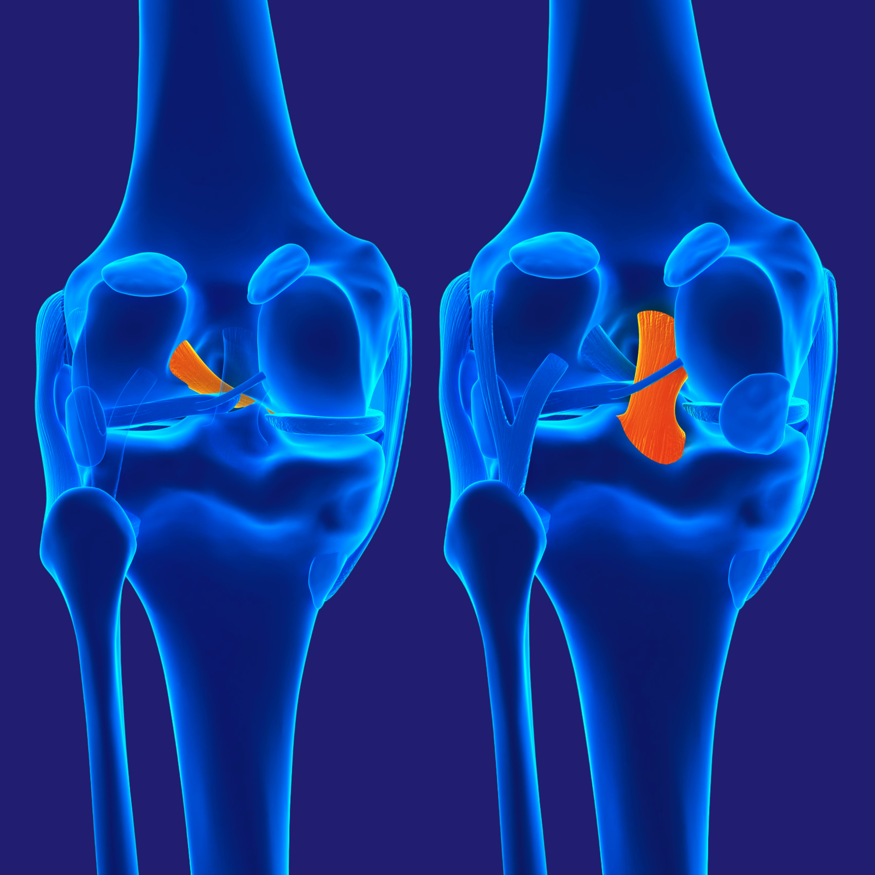 Cruciate Repair & Reconstruction – Osteocare
