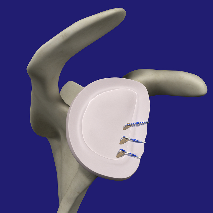 Shoulder Instability Repair – Osteocare