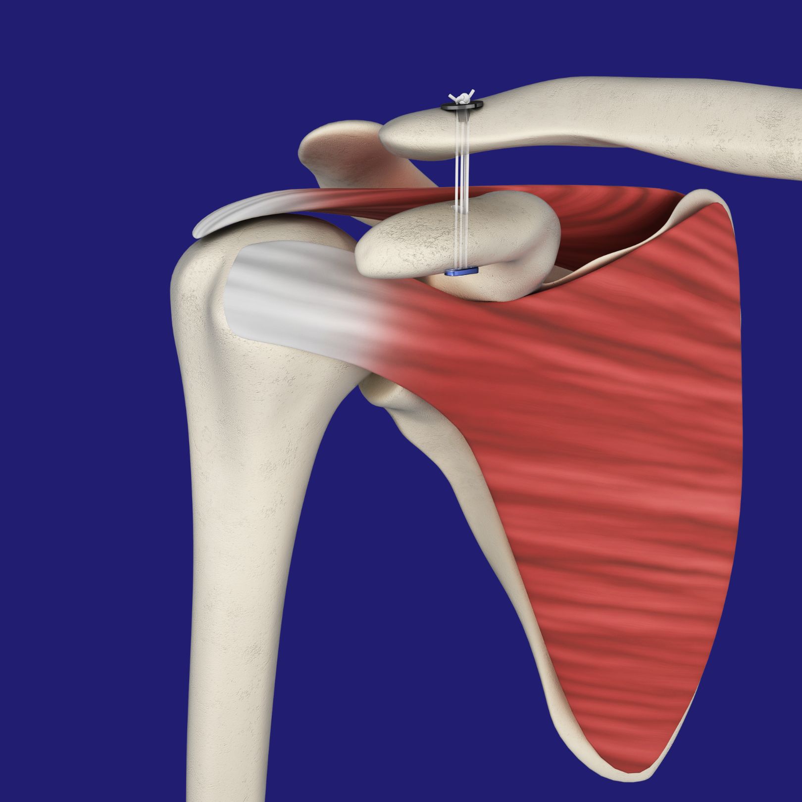 AC Joint Separation Repair – Osteocare