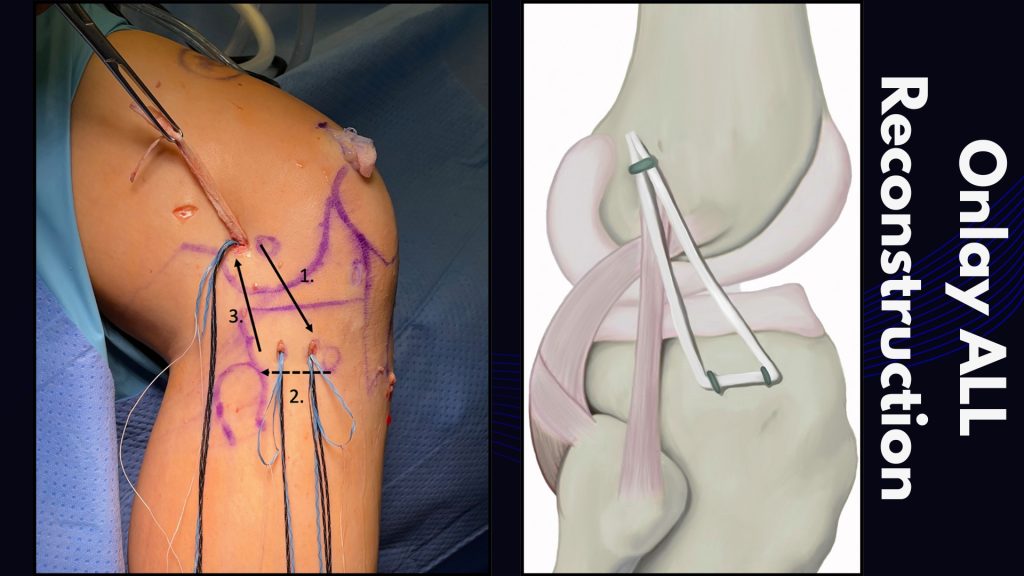 Extra-Articular Tenodesis: Restoring Rotational Stability in ACL ...